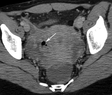 Perforated Versus Nonperforated Acute Appendicitis Accuracy Of