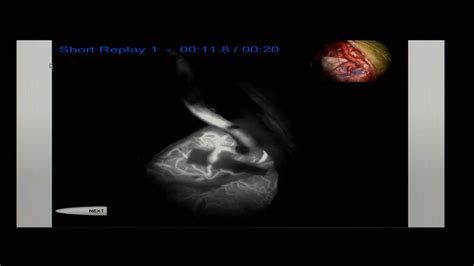 Dr Michael Lawton Sta Mca Bypass Surgery About The Surgeon And Procedure Live Neurosurgery