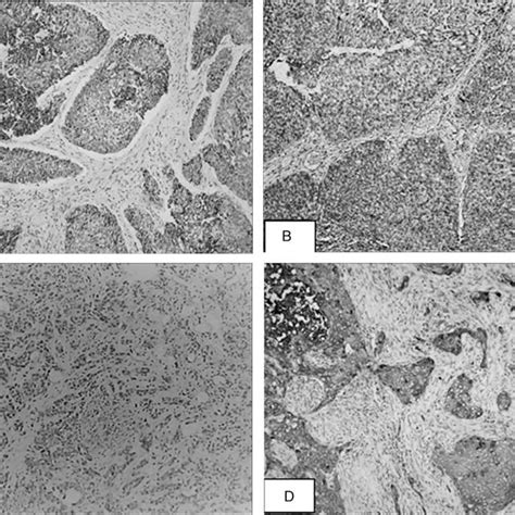 A Reduced E Cadherin Expression Abnormal In Group 3a Download