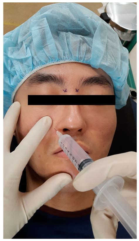 Infraorbital Nerve Block Location Of The Infraorbital Foramen With