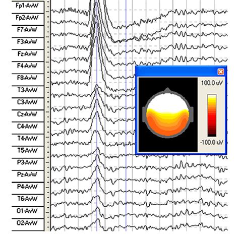 Eeg And Topographical Map Indicate Eye Blink Download Scientific Diagram
