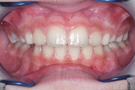 Mandibular Lateral Displacement Mld Dentaldate Dentistry Cases