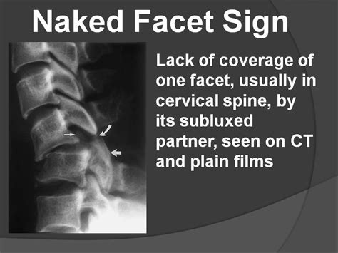Naked Facet Sign Radiology Classroom