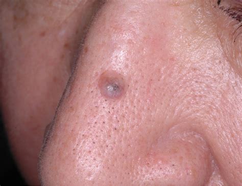 ¿qué Tipos De Cáncer De Piel Existen Y Cómo Tratarlos