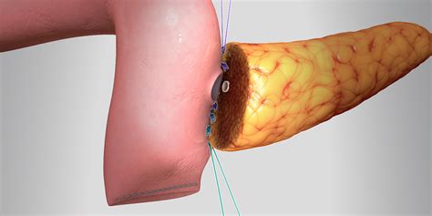 Pancreaticojejunostomia