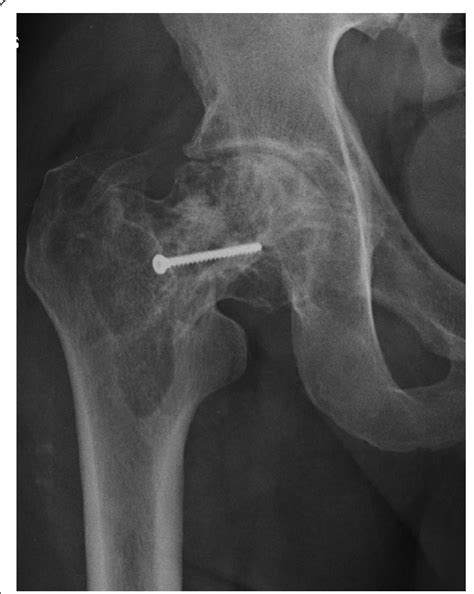 Ap Radiograph Of The Right Hip Showing A Basicervical Femoral Fracture