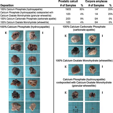 Crystalline Composition Of Prostatic Calculi And Corpora Amylacea Download Scientific Diagram