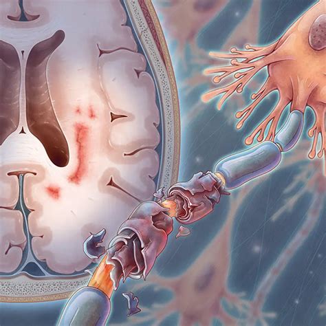 Disseminated Sclerosis Causes Symptoms Treatment Multiple Sclerosis