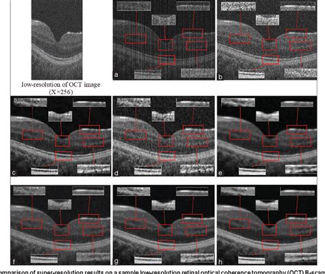 Figure 1 From Super Resolution Of Retinal Optical Coherence Tomography Images Using Statistical