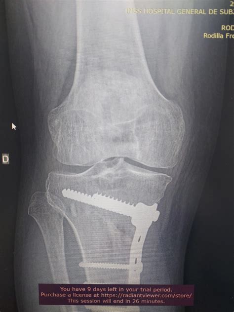 Osteotomia Pata Corregir La Deformidad De La Rodilla En Paciente Joven Urgencias 9581139169