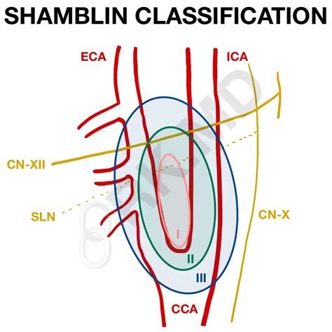 Shamblin Classification Of Carotid Body Tumors Rkmd Shamblin Classification Of Carotid Body Tumors Rkmd