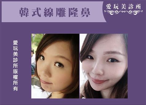 韓式線雕隆鼻 愛玩美診所