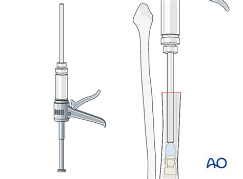Proximal Tibia Replacement For Fracture Around A Loose Tibial Component With Poor Bone Stock