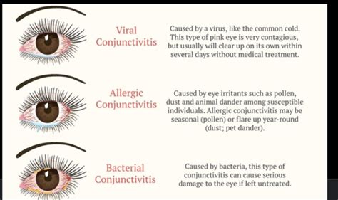 What Is Conjunctivitis Cypress Eye Centre