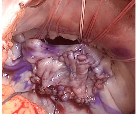 Patch Augmentation Of The Posterior Leaflet With An Autologous Download Scientific Diagram