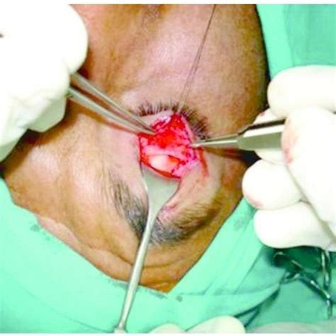 Exposing The Levator Muscle Download Scientific Diagram