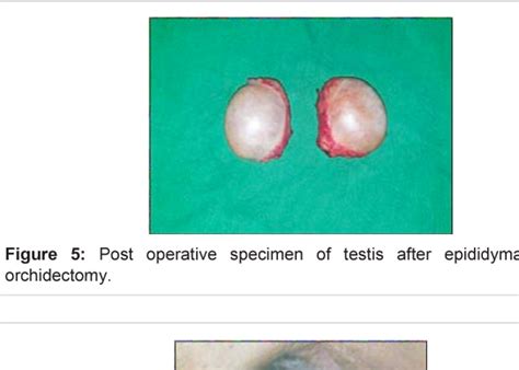 Simple Orchiectomy