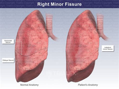 Right Minor Fissure Trialquest Inc