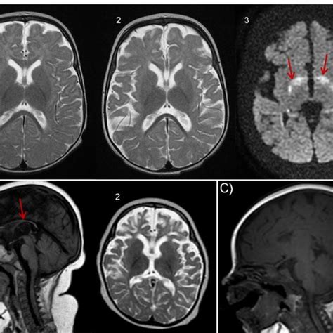 Brain Imaging A Patient 12 T2 Axial Mr Images Show Cortical Atrophy