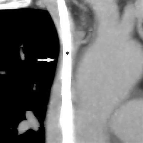 Contrast Chest Ct Scan Multiplanar Reconstruction The Catheter
