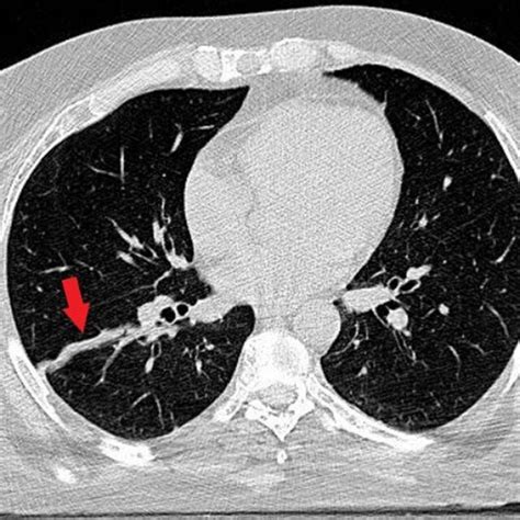 Atelectasis Linear Opacity Of Right Middle Lobe Suggesting Atelectasis Download Scientific