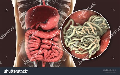 Worms In Humans Stomach