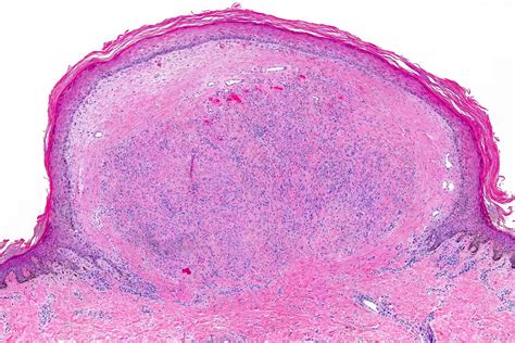 Pathology Outlines Lobular Capillary Hemangioma