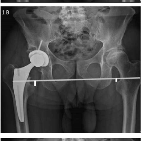 A Acetabular Cup Inclination B Limb Length Discrepancy Lld C Download Scientific