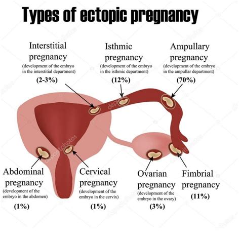 Stunning Info About How To Cure Ectopic Pregnancy Settingprint