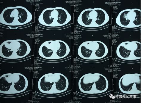 吸入性肺炎的影像特点 MedSci cn
