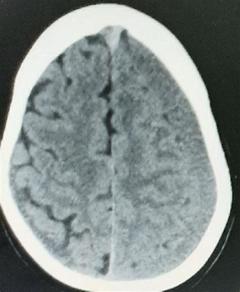 Subacte Sdh Left Frontoparietal Convexity And Rt High Parietal Area