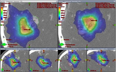 Dose Distributions For Patient 3 From The Avm‐vmat Volume‐staged Plans
