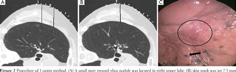 Thoracoscopic Wedge Resection Semantic Scholar