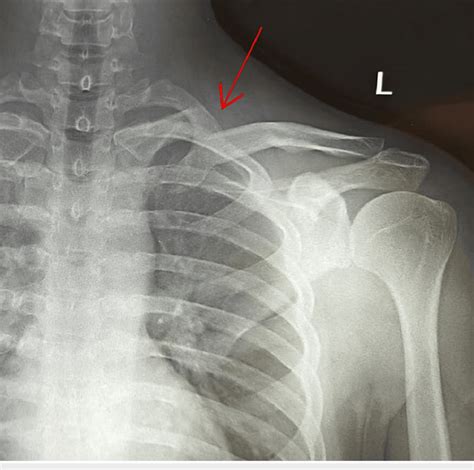 Left Shoulder Ap View Showing Displaced Medial End Clavicle Fracture