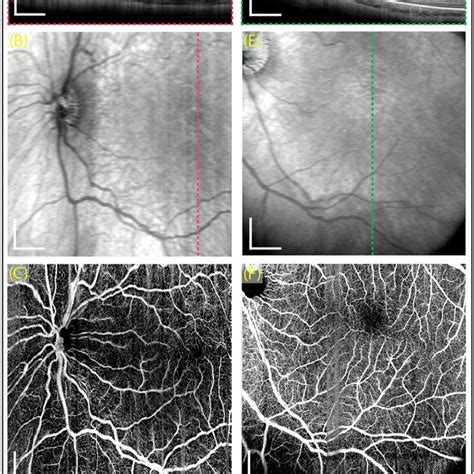 Representative Swept Source Optical Coherence Tomography Angiography Download Scientific