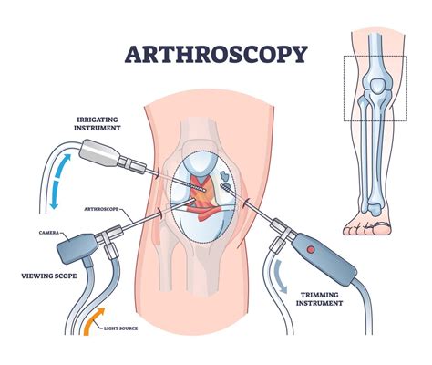 What Is Arthroscopy Or Arthroscopic Surgery