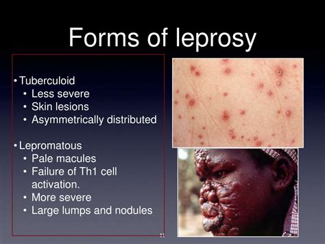 Ppt Leprosy Powerpoint Presentation Free Download Id3060390