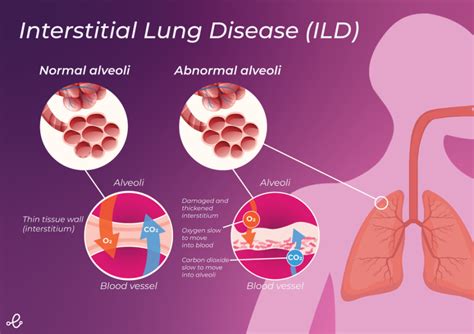 The Ild Patient Journey And What To Expect Cambridge Network