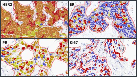 Breast Ihc Ai Indica Labs