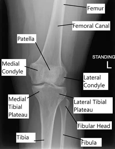 Knee Replacement Surgery Specialists In Ny Complete Orthopedics