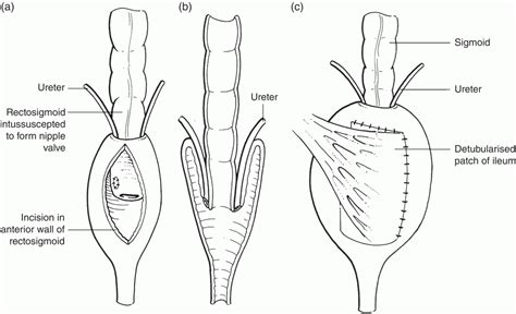 Urinary Diversion Abdominal Key