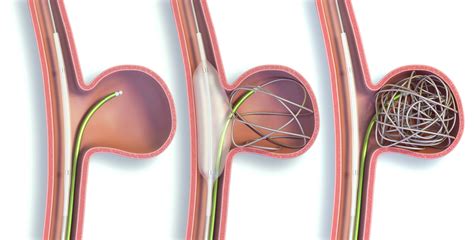 Coil Embolization Ruptured Aneurysm At Ben Vincent Blog