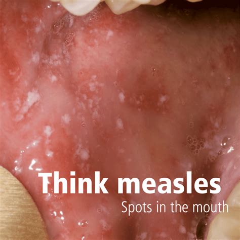 Think Measles