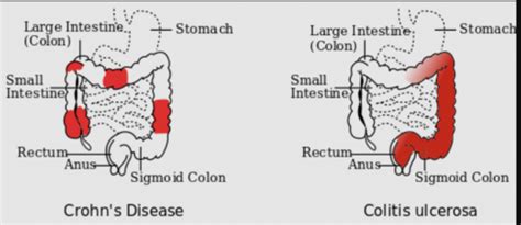 Crohns Disease Symptoms Diagram Treatment For Crohns Disease Program