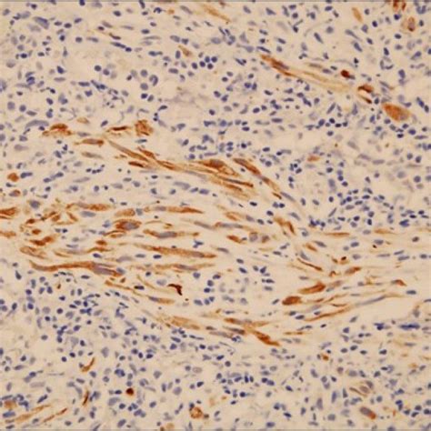 Pathology Collected On The Third Transurethral Resection Of The Bladder Download Scientific