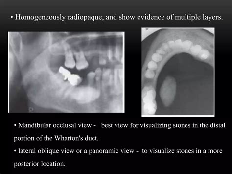 Soft Tissue Calcifications Of The Oral Cavity Pptx