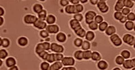 Examen General De Orina Examen Miscroscopico Eritrocitos