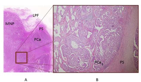 Prostatic Adenocarcinoma With Pseudocapsule Sato World Journal Of Nephrology And Urology