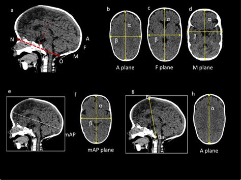 Skull Shape Severity Quantification Using Traditional Cephalic Index Download Scientific