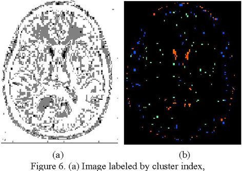 Figure 6 From Mri Brain Image Segmentation Using Modified Fuzzy C Means Clustering Algorithm